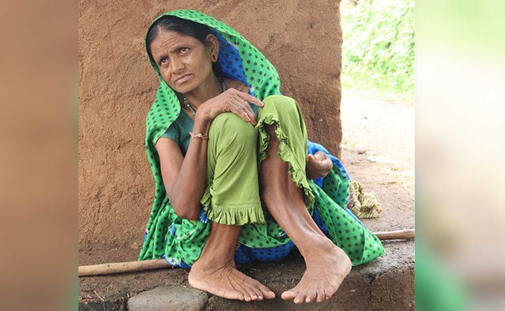 Fluoride Action Network How Fluorosis Is Crippling India And Needs