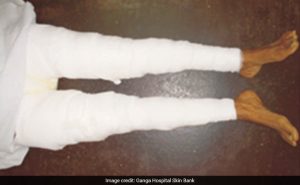 An A-Z Guide To Skin Donation And Transplantation In India | NDTV ...