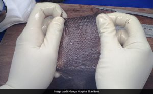 An A-Z Guide To Skin Donation And Transplantation In India | In Focus